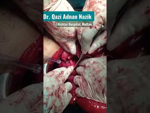 Exploratory Laparotomy | #mbbsmotivation #doctorslife