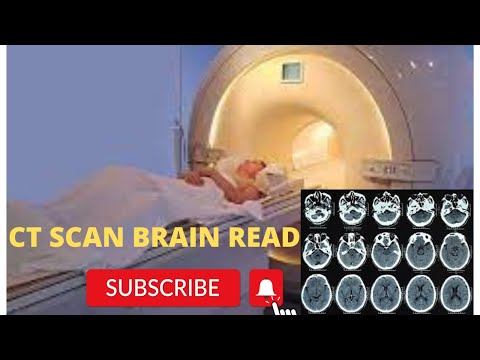 Normal Head CT Scan Anatomy !!