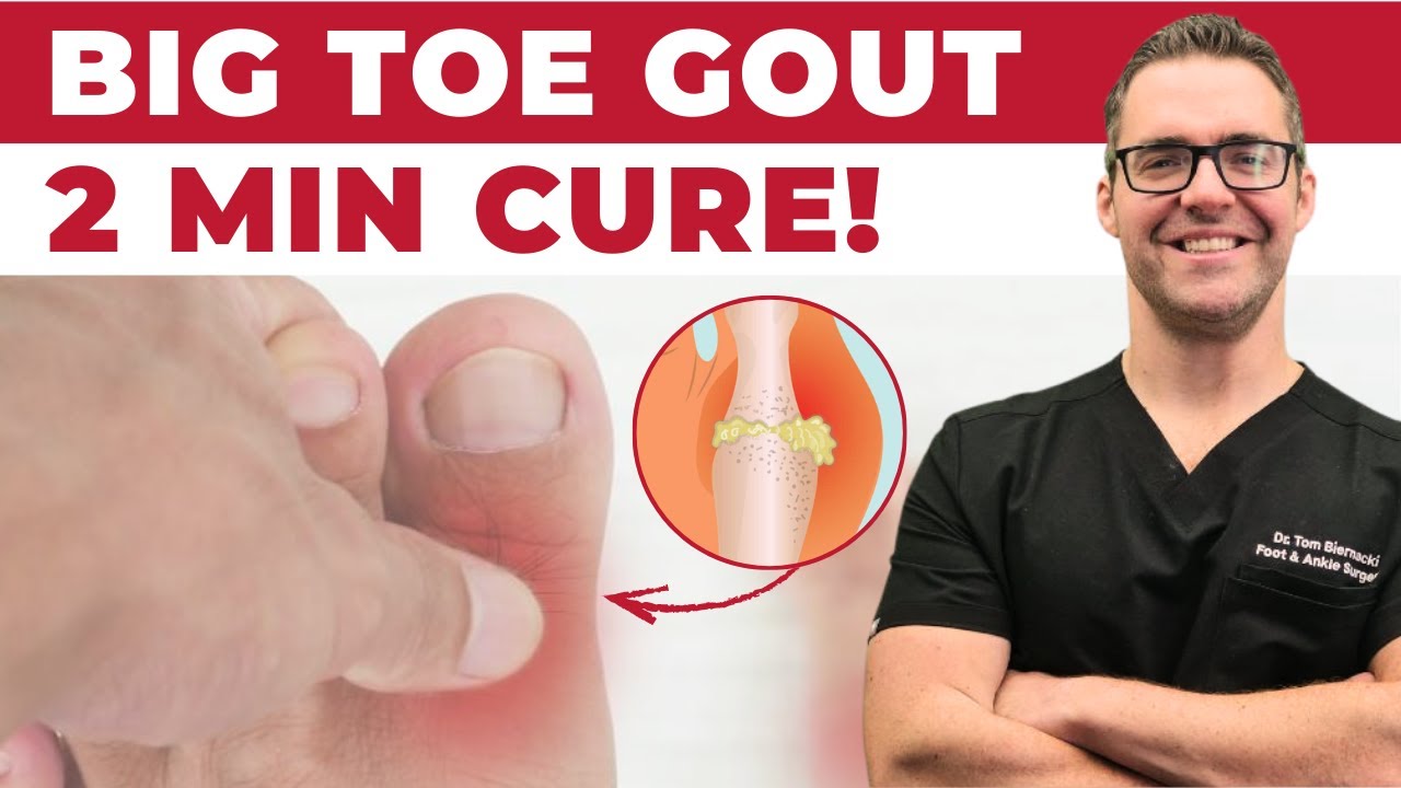 Gout Attack in the Big Toe Joint & Foot Diet & Treatment *2 MINUTES!*