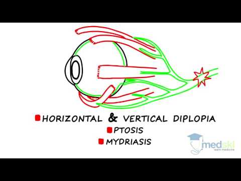 Ophthalmology – Diplopia: By Martin ten Hove M.D.