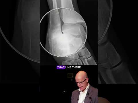 Ankle injury - Maisonneuve fracture