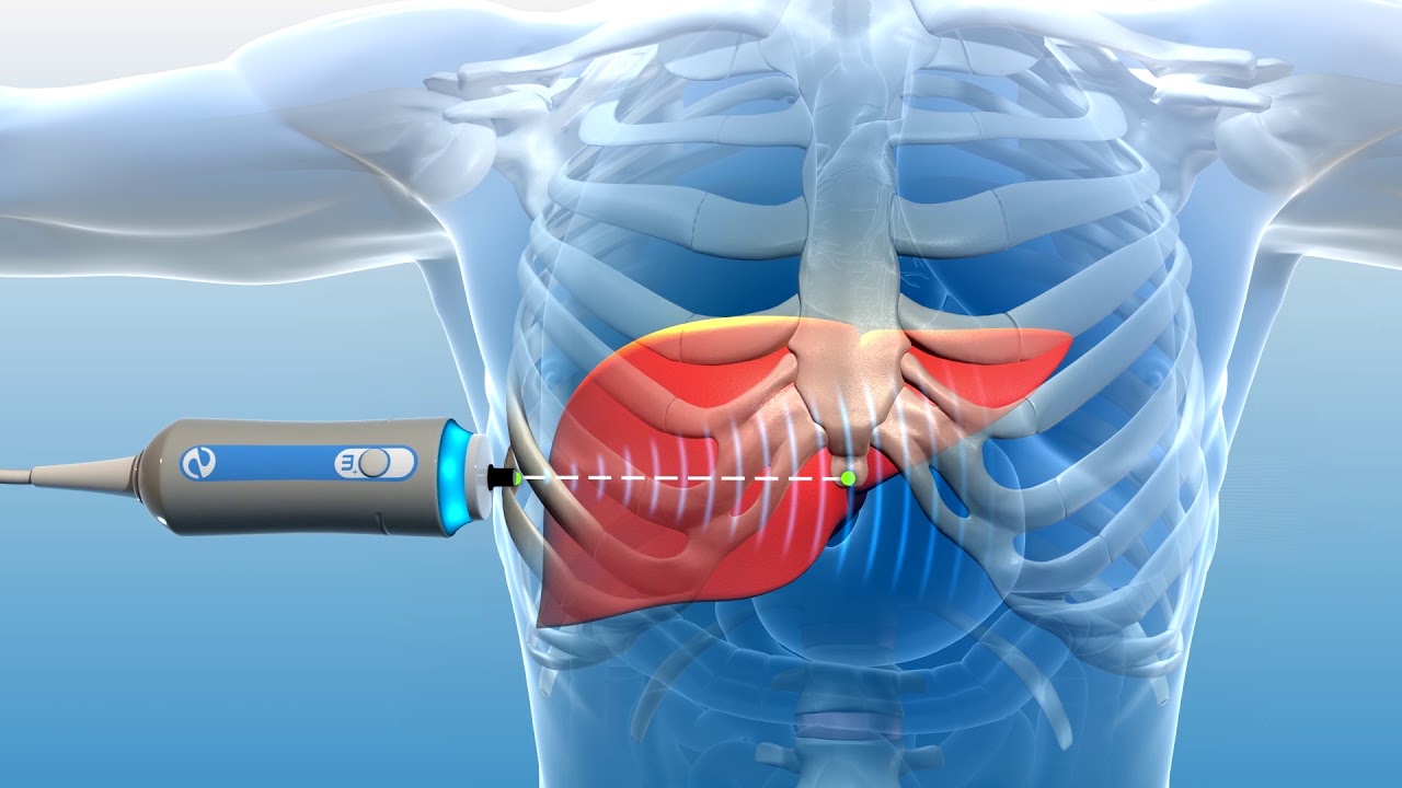 An Introduction to FibroScan | Ohio State Medical Center