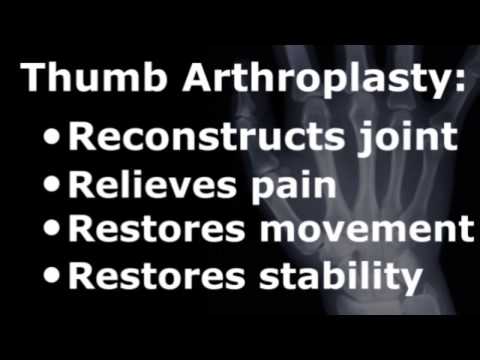 Thumb CMC Arthroplasty - Thumb Joint Reconstruction