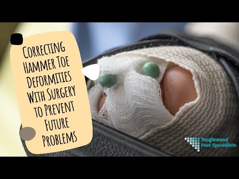 Correcting Hammer Toe Deformities With Surgery to Prevent Future Problems