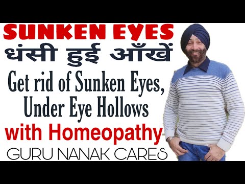 SUNKEN EYES | Under Eye Hollows | Tear Trough Deformity | धंसी हुई आँखें और उनका होम्योपैथिक उपचार