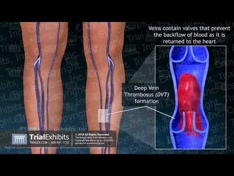 Surgical Placement of Inferior Vena Cava Filter to Prevent DVT
