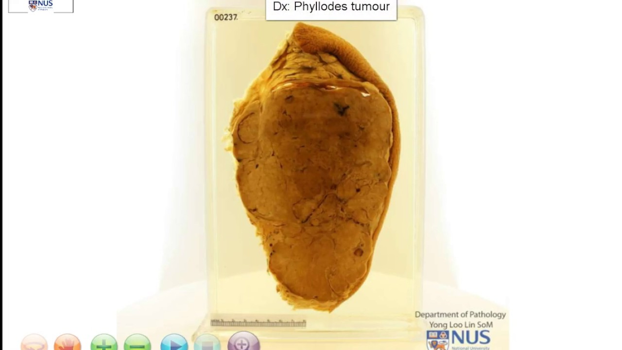Breast: Phyllodes tumour gross and microscopy