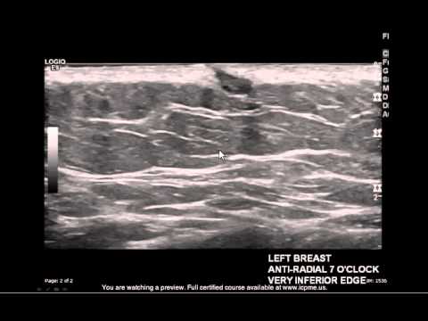 Digital Breast Tomosynthesis: calcifications, lymph nodes, and stable masses