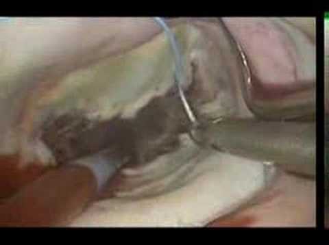 Minimally Invasive Beating Heart MVR in Severe Dilated Cardi