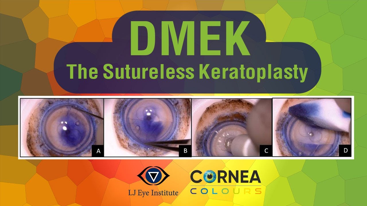 Understanding DMEK: The Sutureless Keratoplasty Technique | Galaxy.ai
