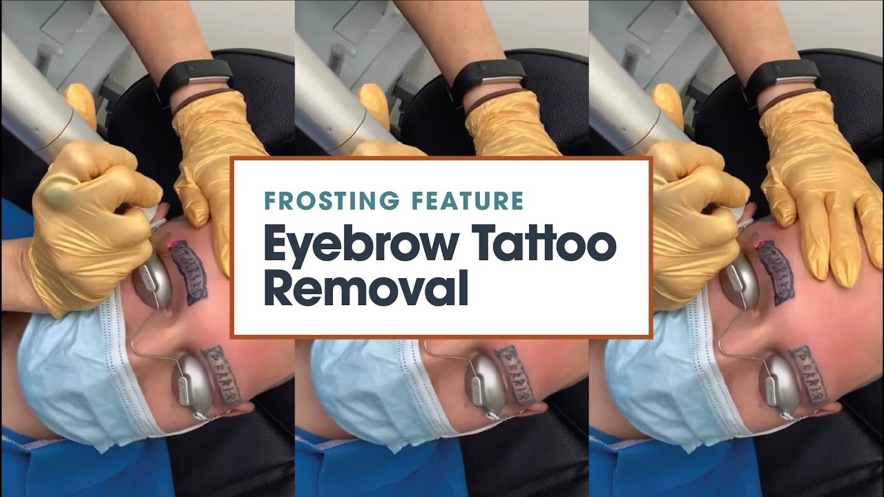 ❄ Frosting Feature ❄ Eyebrow Tattoo Removal | Removery