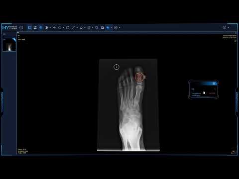 Dr.Turing-03-AI for Bone Rupture