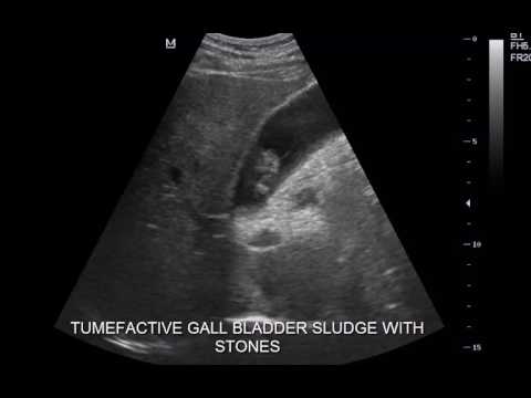 CASE 288 TUMEFACTIVE GALL BLADDER SLUDGE
