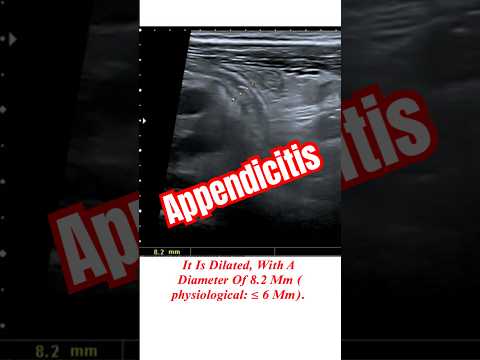Acute appendicitis #appendicitis