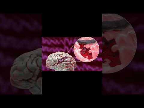 What are the types of stroke?