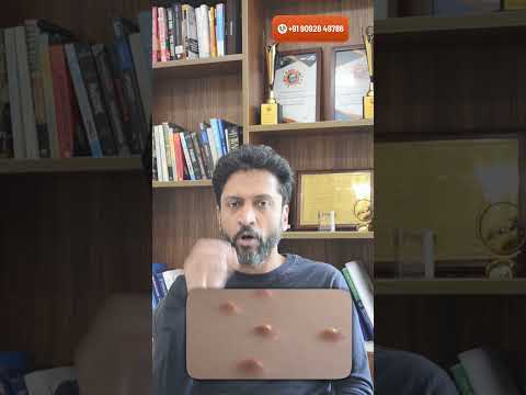 மிகவும் பொதுவான வகை விதைப்பை நீர்க்கட்டி எது..? | What is the most common type of scrotal cyst..?