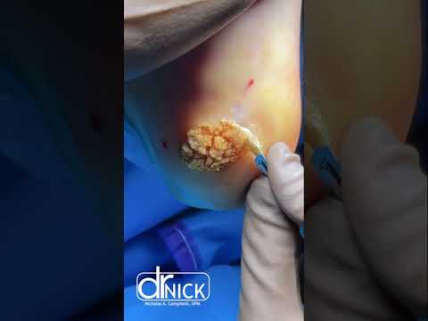 Removing a MASSIVE Plantar WART!! #shorts