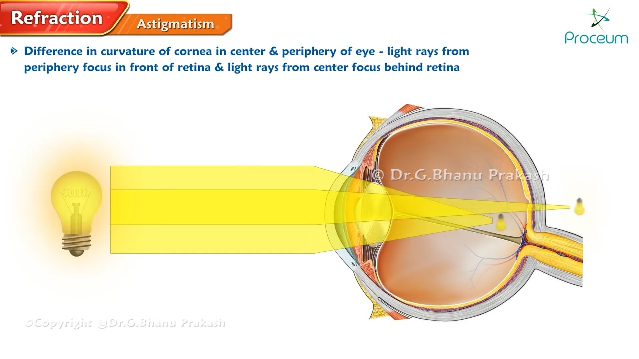 Understanding Refractive Errors of the Eye: A Comprehensive Guide | Galaxy.ai