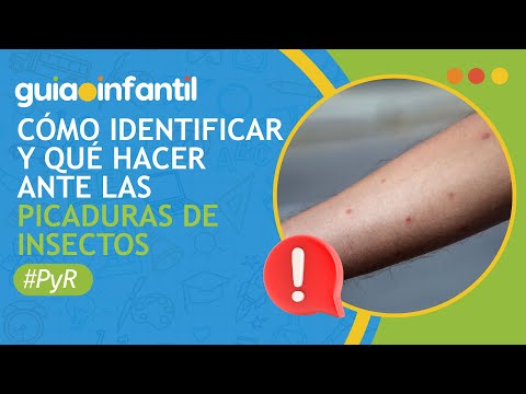 Cómo diferenciar y curar las PICADURAS de INSECTOS en niños 🦟🕷️🐝 | Cómo aliviar los picores #PyR