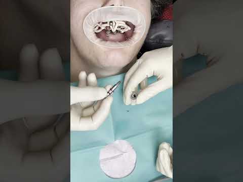 Dental implant’s All on 4 in Prague #shorts #dentist #dental #implant #veneers #short