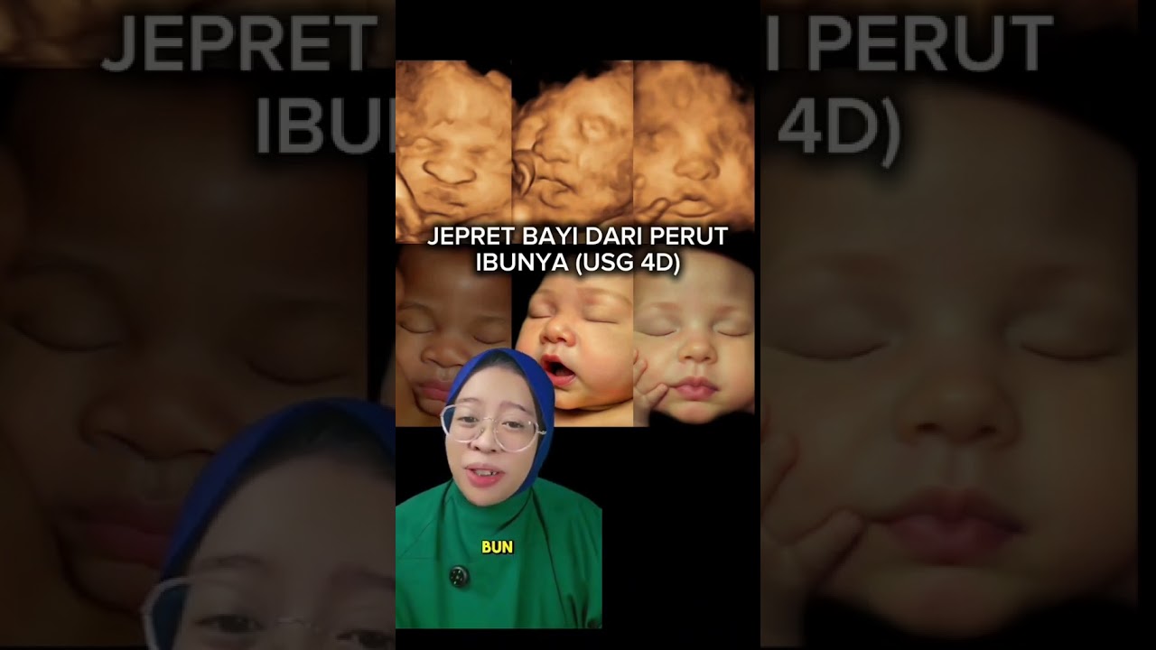 USG 4D Bisa Lihat Muka Bayi Secara Jelas Lhooo Bun