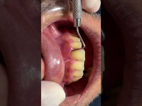 VERY BIG LESION periodontal #dentistry #periodontist #periodontaltherapy #periodontitis #dentist