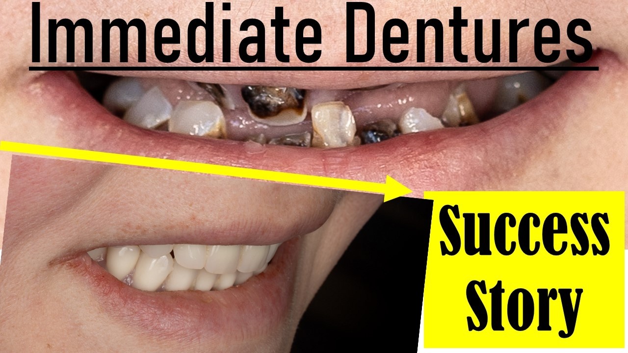 Immediate Dentures! A Success Story.