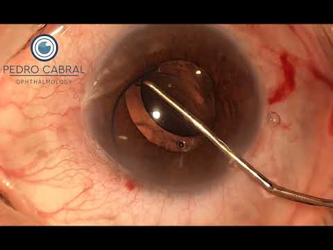 Sulcus implant IOL (3 pieces) after posterior capsular rupture By dr. Pedro Cabral