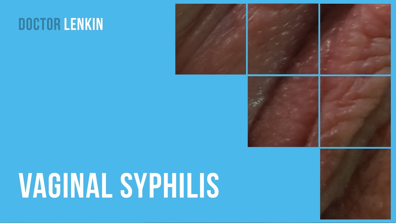 👩 Vaginal syphilis