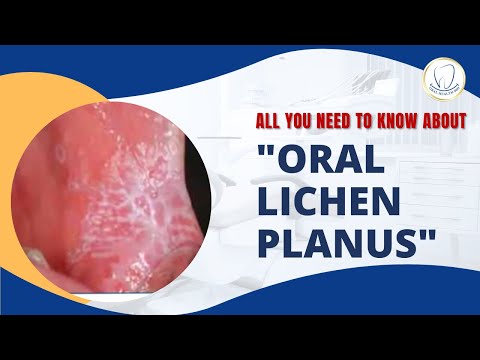 Everything you need to know about oral lichen planus #OralHealth360