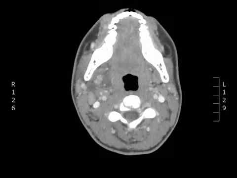 Sialoadenitis