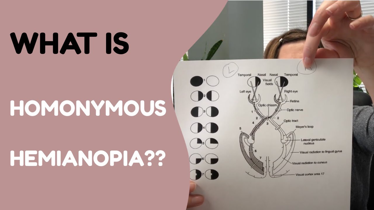 What is Homonymous Hemianopia?