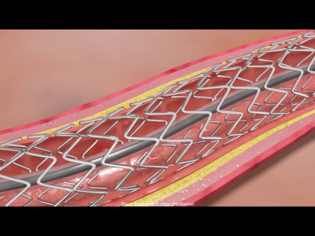 Medtronic - Resolute Integrity Coronary Stent Trader - Wholesaler ...