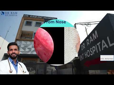 Endoscopic Foreign Body Camphor Kapur Removal From Nose