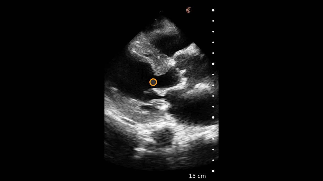 Concentric Left Ventricular Hypertrophy (LVH) - Ultrasound Image Interpretation