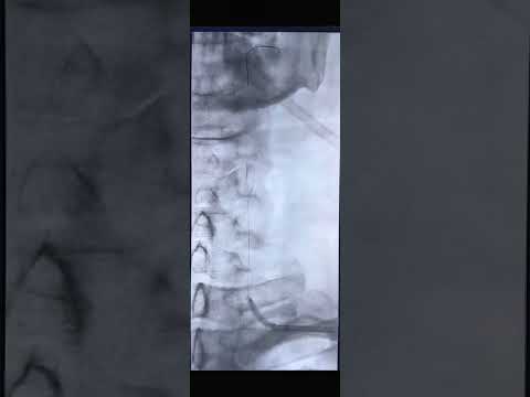 Treatment of Vertebral Artery Stenosis: Radial Approach