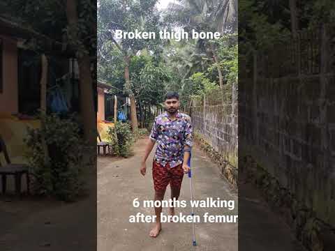 6 months walking after broken femur#brokenbone #brokenleg #femur #bone
