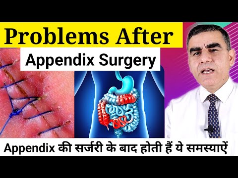 अपेंडिक्स की सर्जरी के बाद होने वाली समस्याएं | Problems After Appendix Surgery | Appendicitis