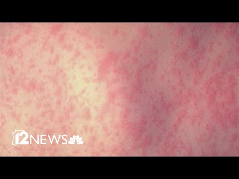 1,197 confirmed measles case across the nation