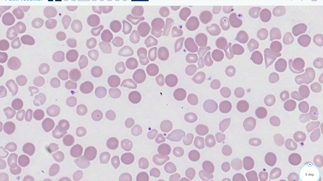 Hereditary Spherocytosis #pathagonia