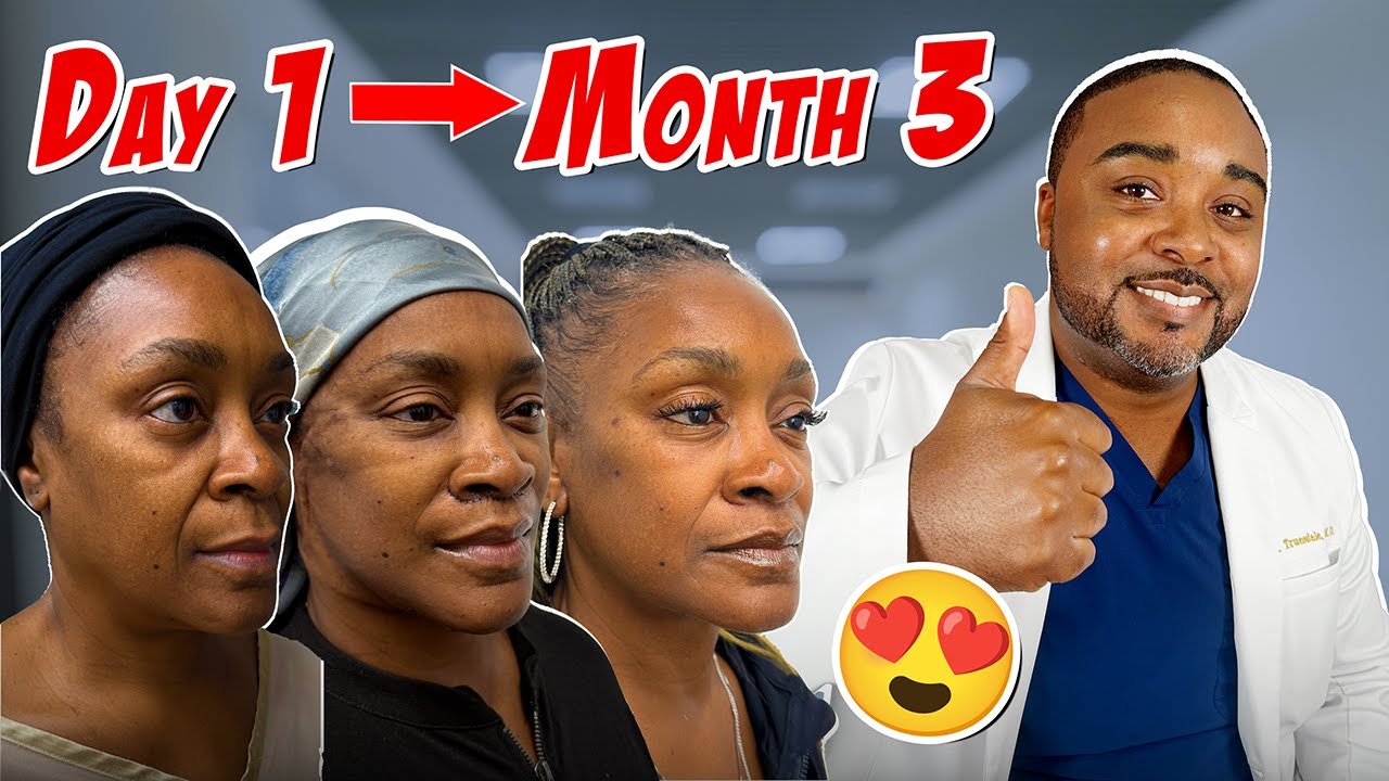 From Swelling to Stunning: A Week by Week Facelift Recovery Timeline