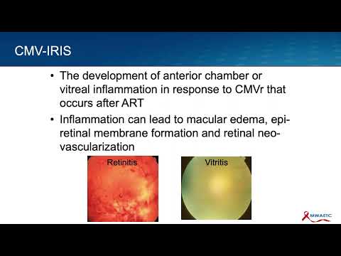 Immune Reconstitution Syndrome, 2023: Part 1 of 2
