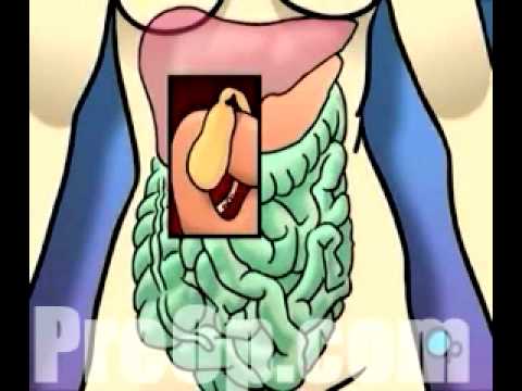 PreOp® Patient Education Gallbladder Removal Laparoscopic Ha