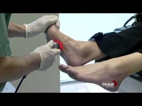 Foot Pain Laser Treatment - Toronto, Ontario - Podiatrist Sheldon Nadal, DPM