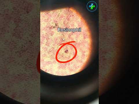 Eosinophil | White blood cell | Peripheral Smear #medicallaboratory #bloodtest #medicallab