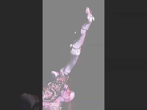 finger CT scan 3D | fracture of Distal phalanx #siemens #trending #video #medical #ctscan #finger