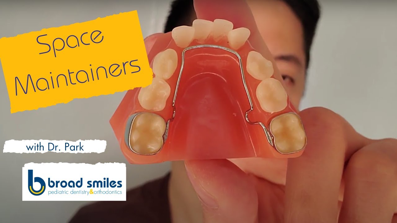 Everything You Need to Know About Spacers and Space Maintainers - Broad Smiles Pediatric Dentistry