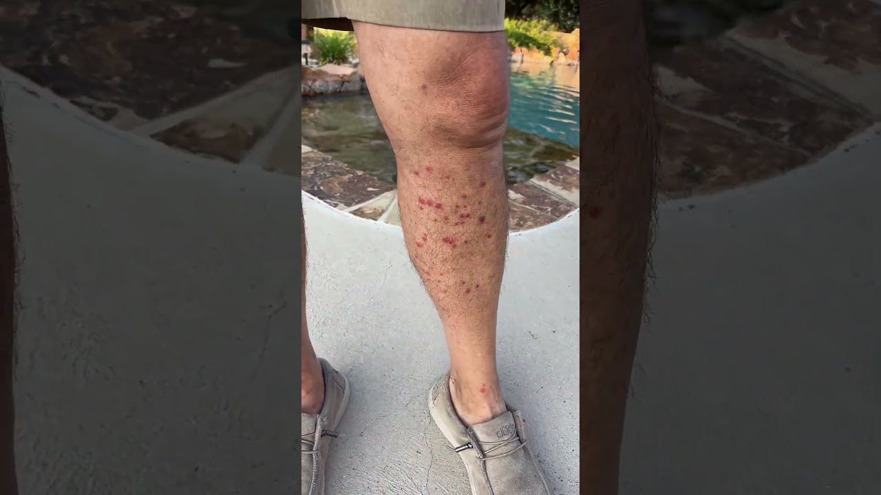 Chigger Bite Prevention: How to Keep Chiggers Off Your Legs and Skin#chiggers #bugbites