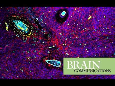 The comparable tumour microenvironment in sporadic and NF2-schwannomatosis vestibular schwannoma