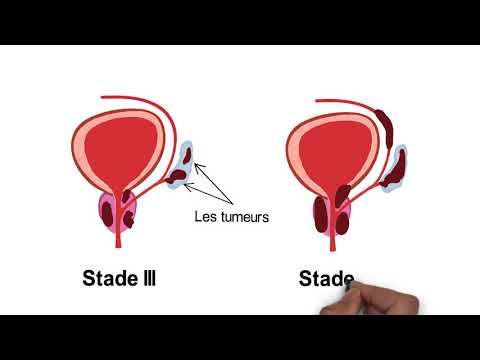Comprendre le cancer de la prostate